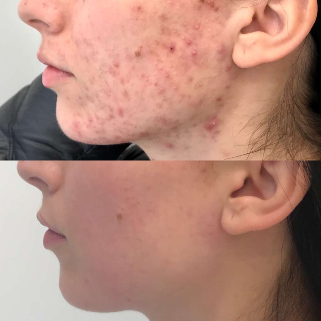 Kako nam lahko dermatolog pomaga pri aknah? - Nepremagljiva.si